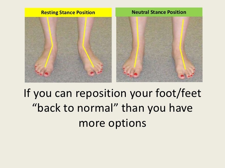 Painful Adult Acquired Flatfoot - Treatment Options