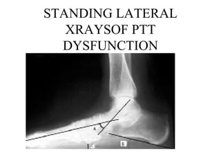 Adult aquired flatfoot | PPT