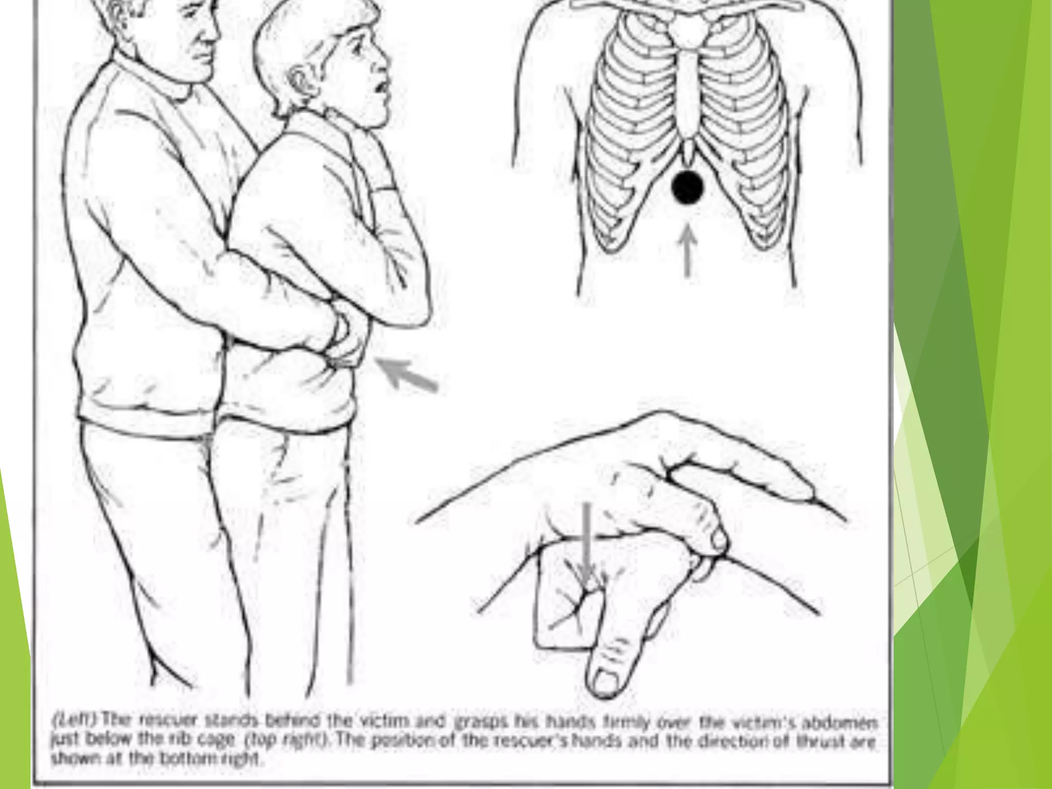BASIC LIFE SUPPORT (ADULT) BLS | PPT
