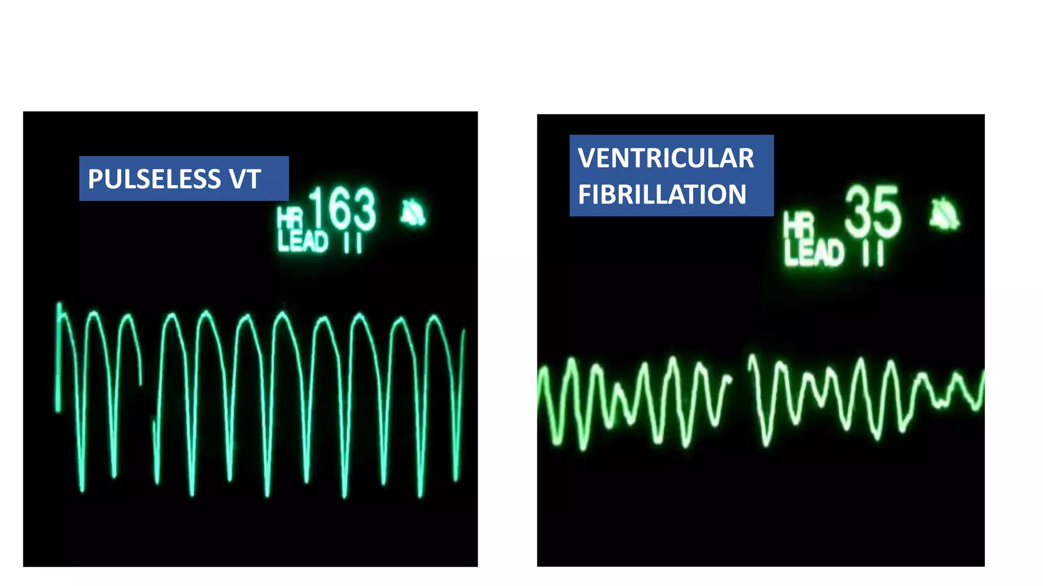 ADULT BLS AND ACLS.pptx