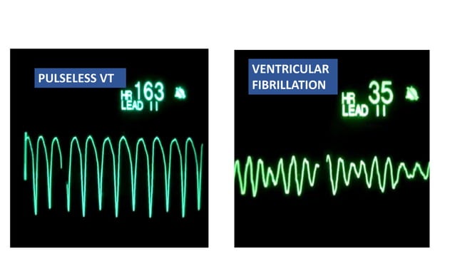 ADULT BLS AND ACLS.pptx | First Aid | Injuries