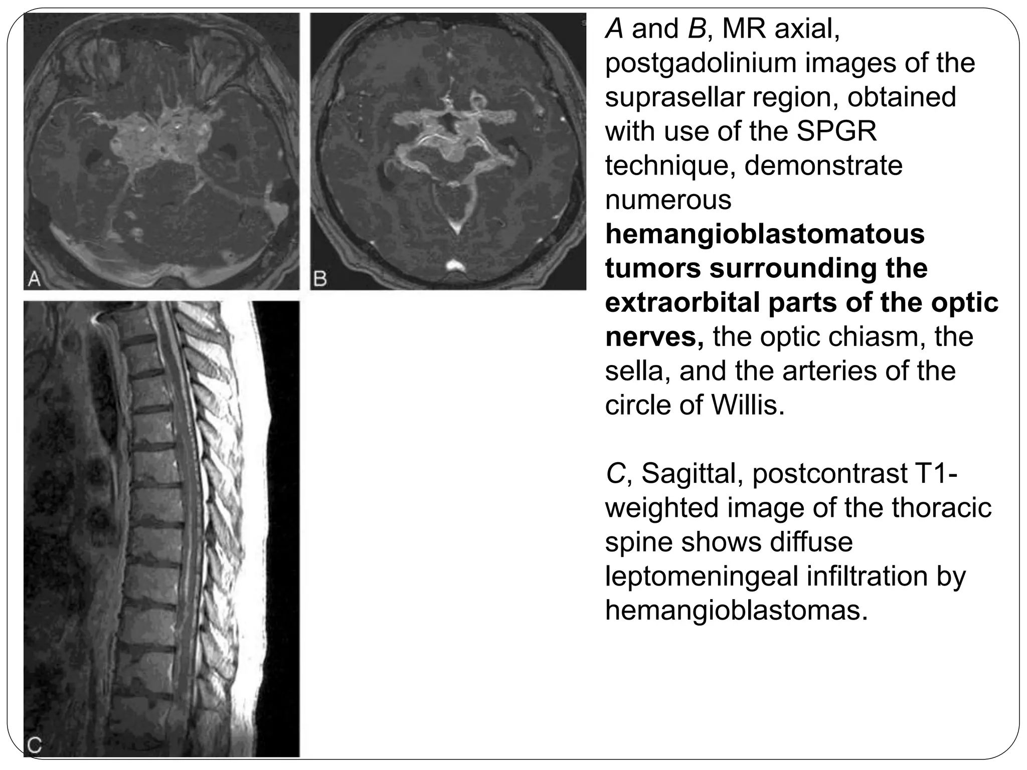 Adult brain tumors imaging | PPTX