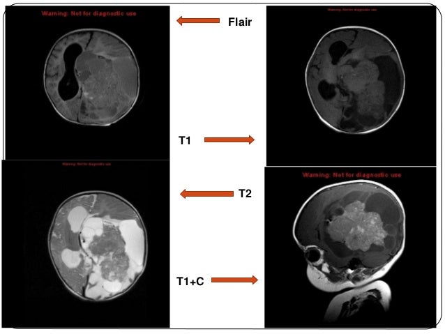 Adult Brain Tumors Imaging