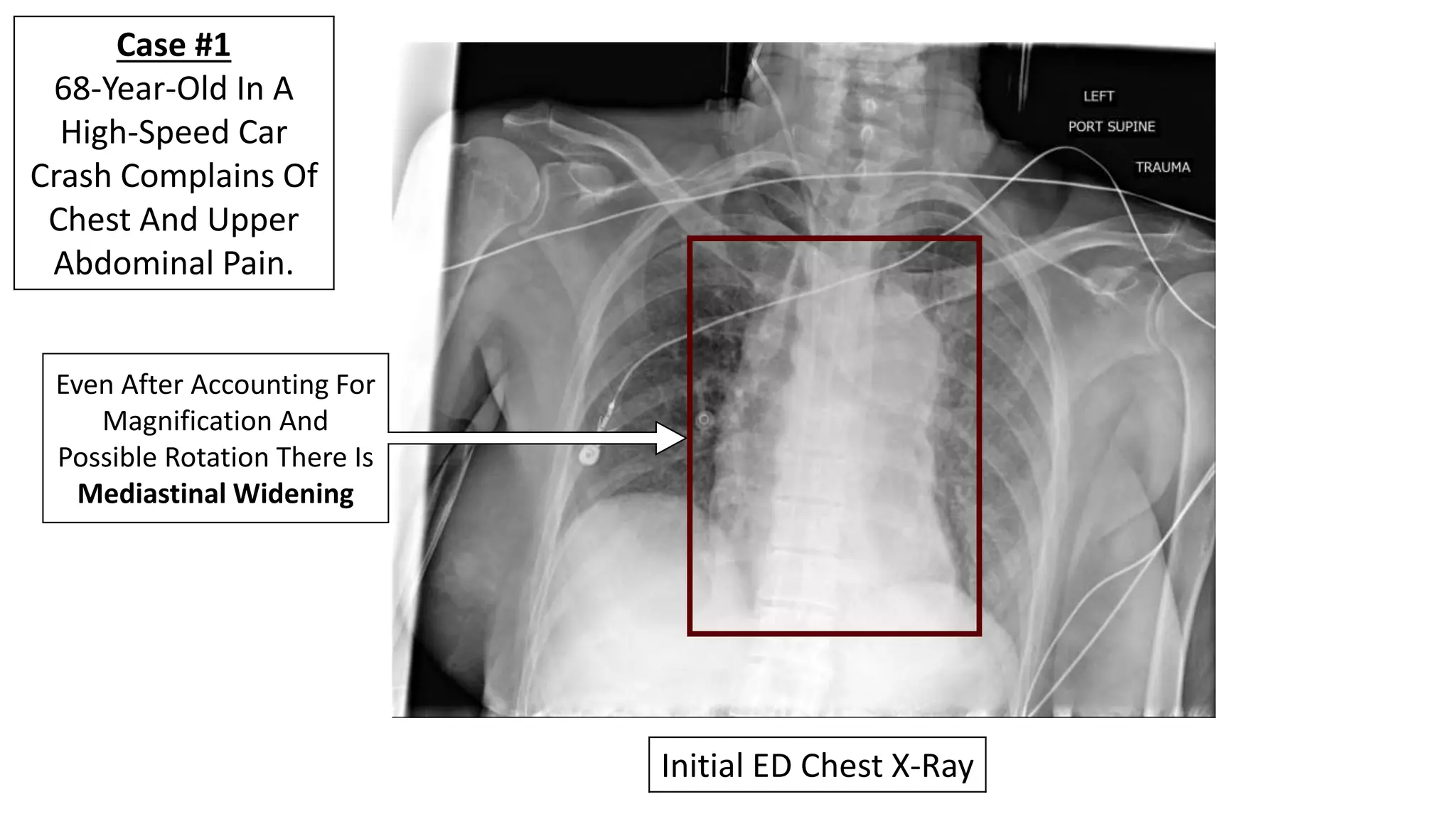 Adult Chest X-Rays Of The Month - #46 | PPTX