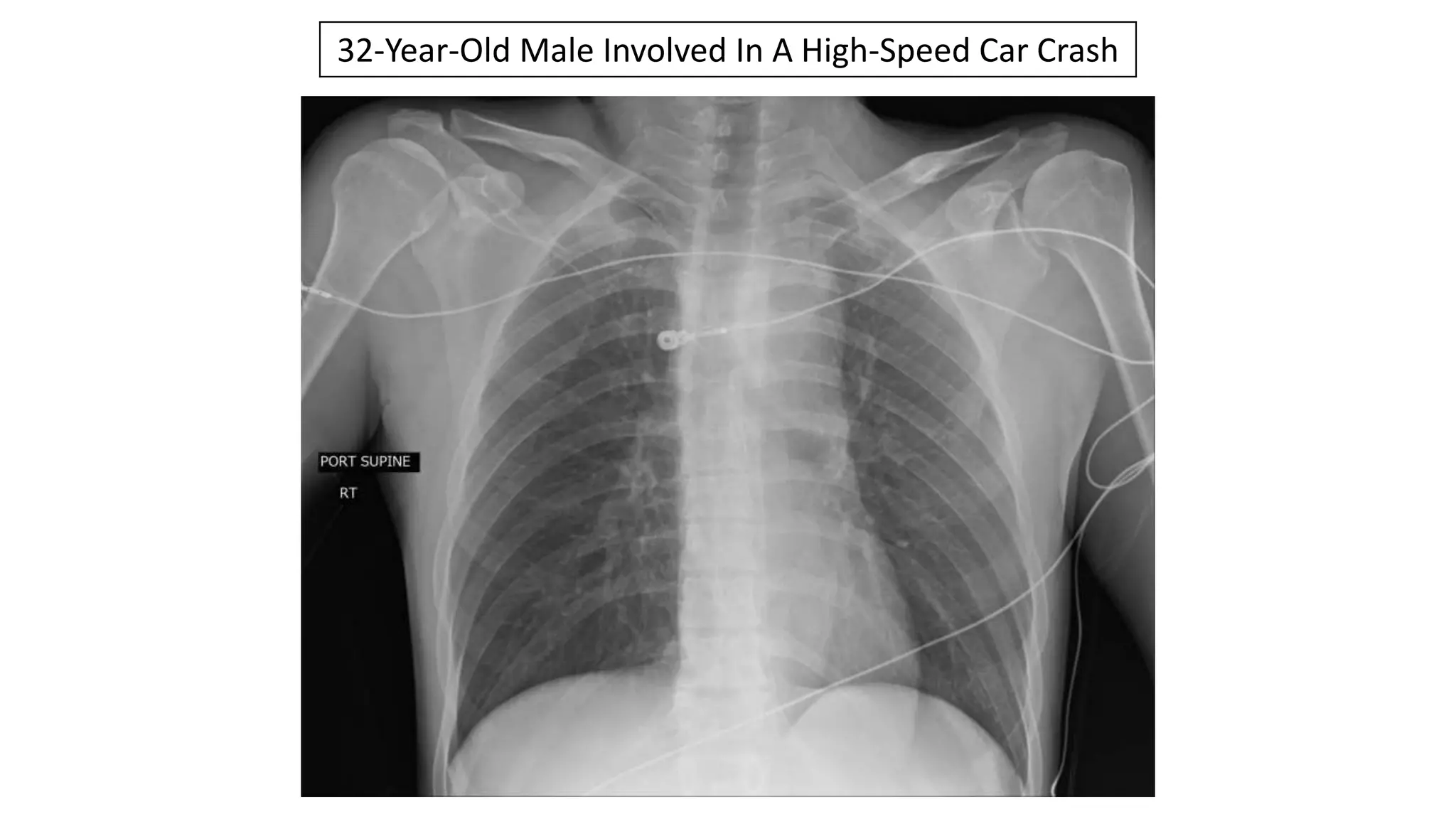 Adult Chest X-Rays Of The Month - #46 | PPT