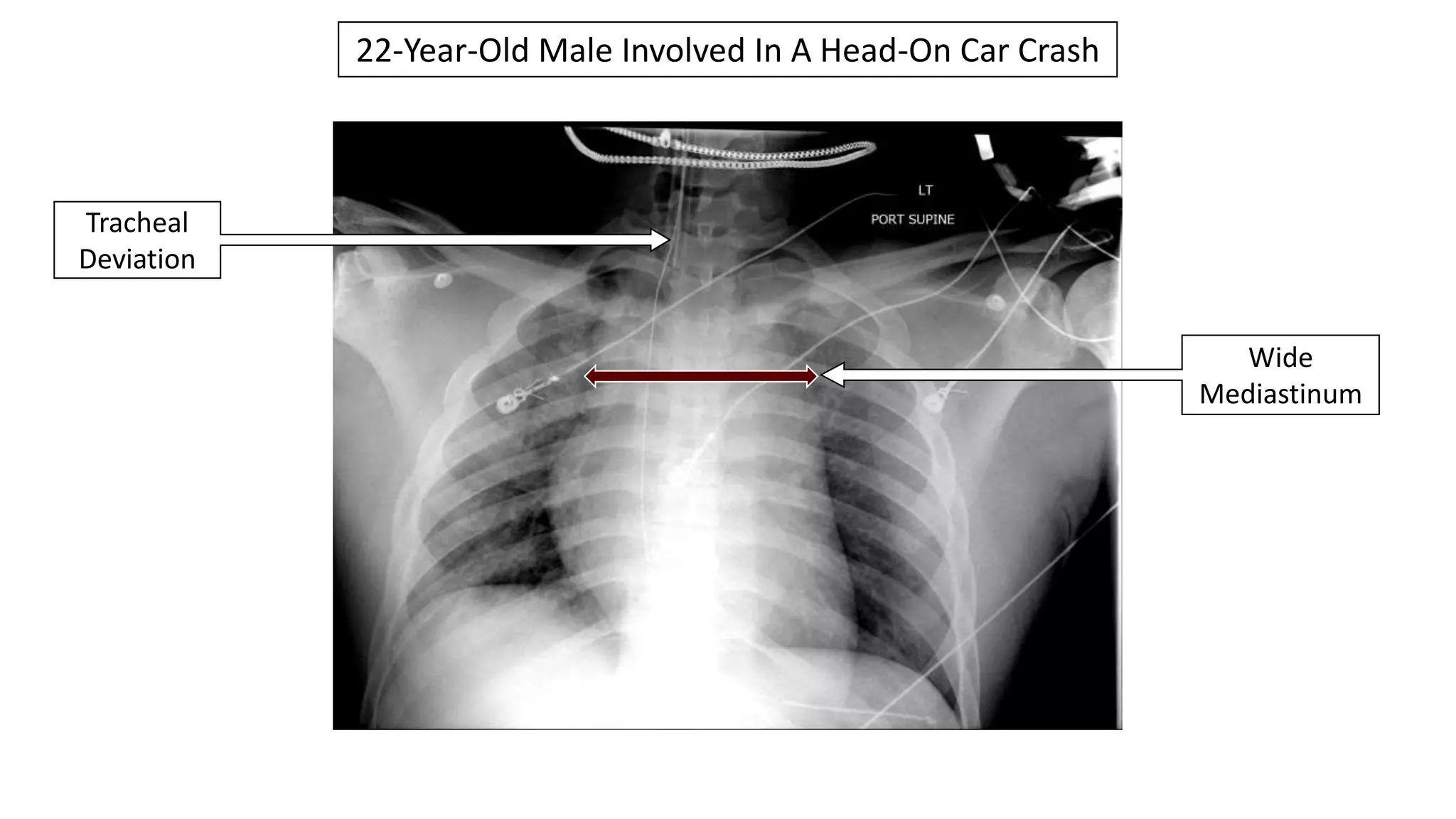 Adult Chest X-Rays Of The Month - #46 | PPT