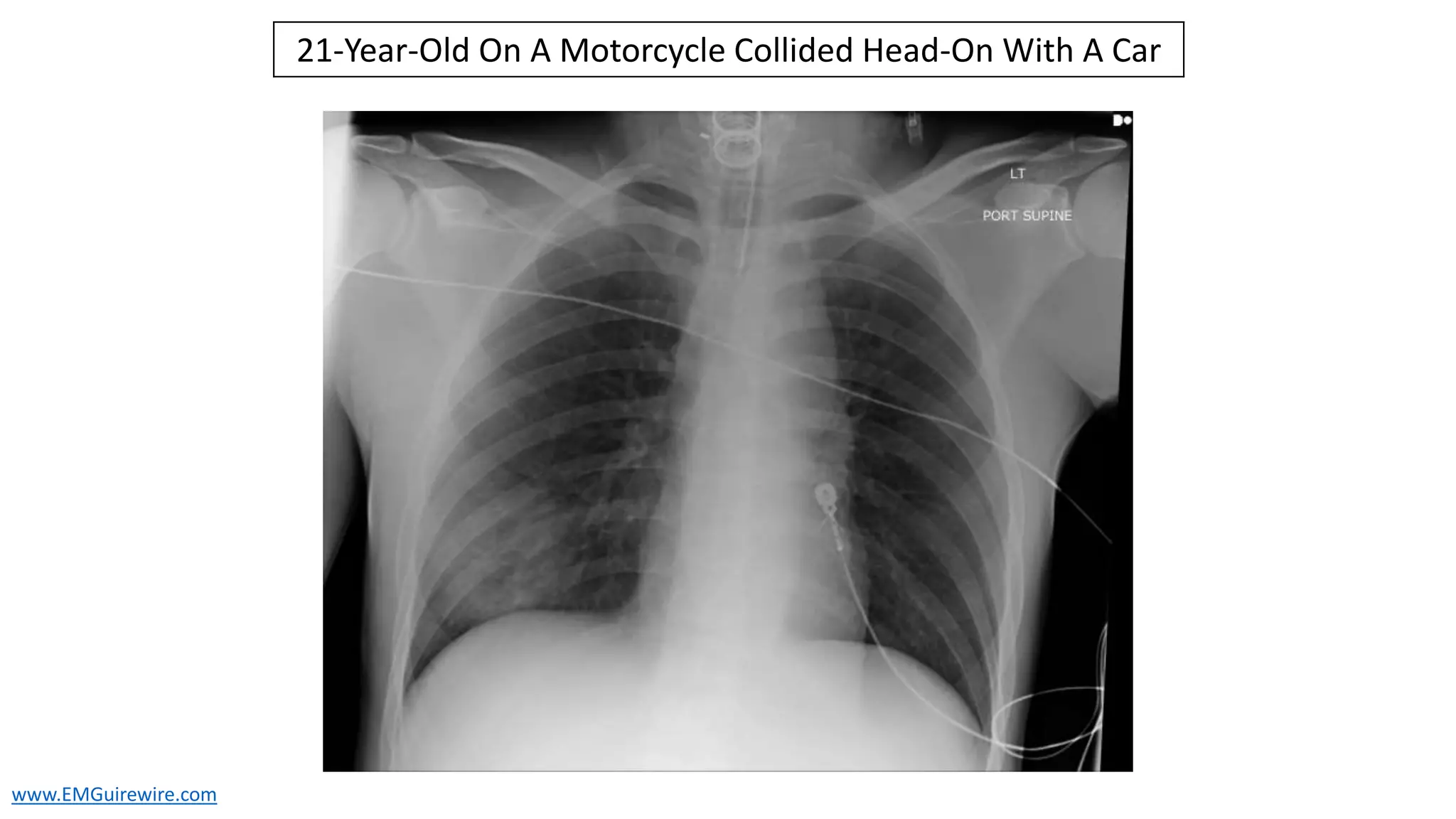 Adult Chest X-Rays Of The Month - #46 | PPT