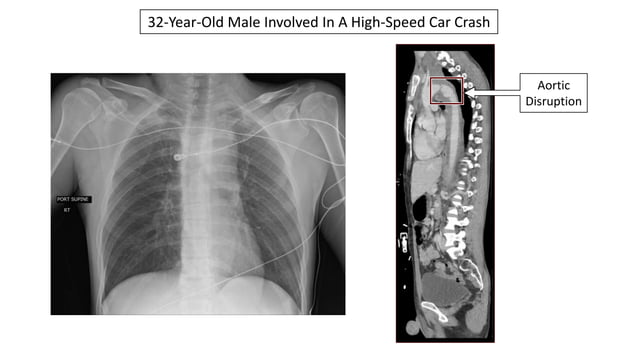 Adult Chest X-Rays Of The Month - #46 | PPT