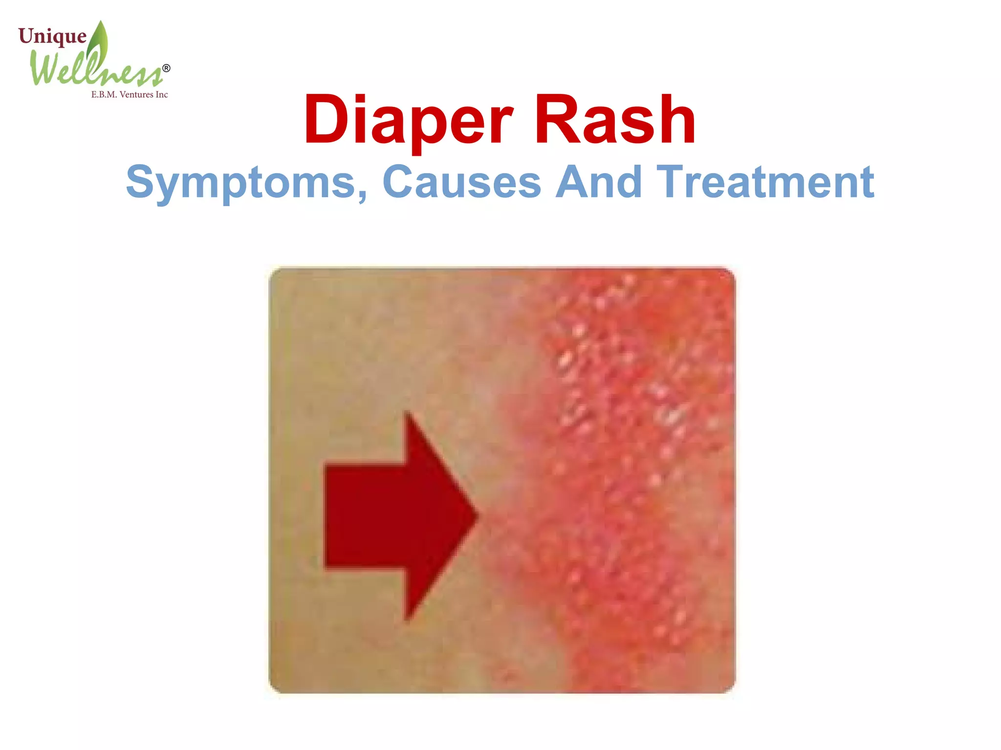 Adult diaper rash: Symptoms, Causes and Treatment | PPT