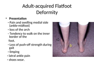 Acquired adult flat foot Power Point Foot and ankle | PPT