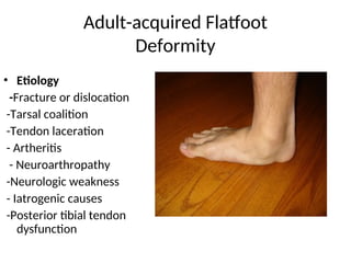 Acquired adult flat foot Power Point Foot and ankle | PPT