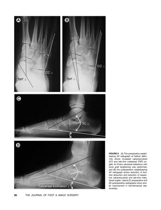 Adult flat foot review | PDF