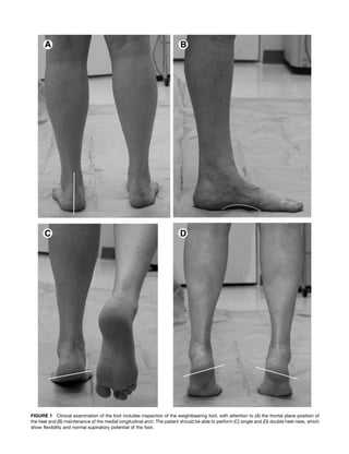 Adult flat foot review | PDF