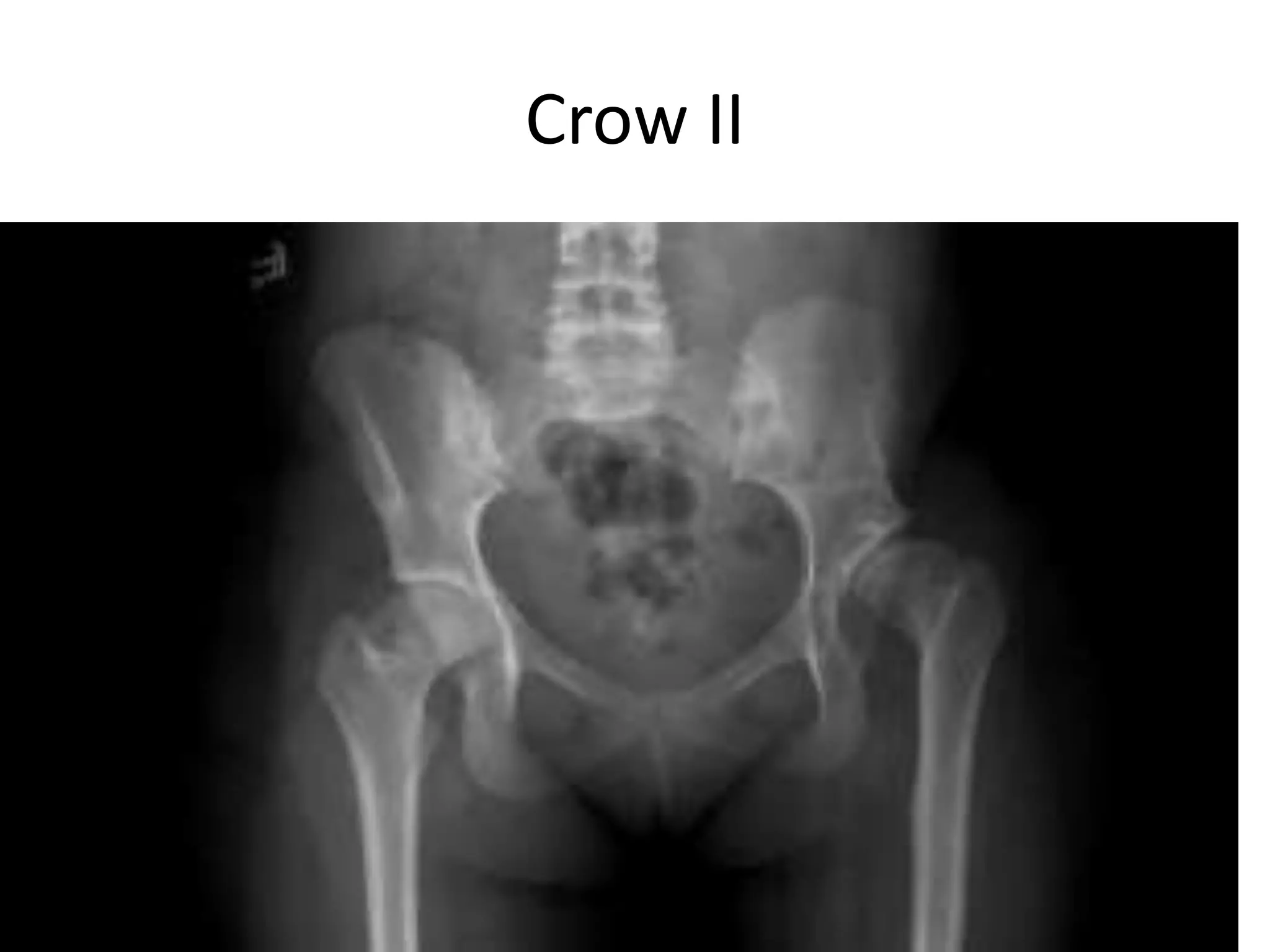 Adult hip dysplasia | PPTX