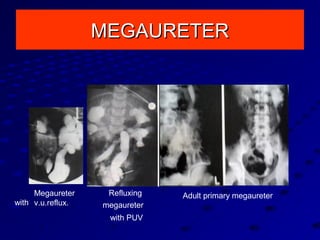 Adult megaureter | PPT