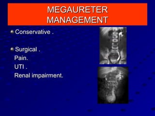 Adult megaureter | PPT