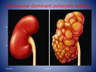 Adult polycystic kidney disease | PPT