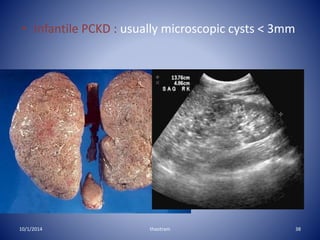 Infantile Polycystic Kidney Disease Ultrasound