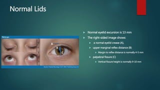Adult ptosis | PPT