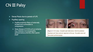 Adult ptosis | PPTX