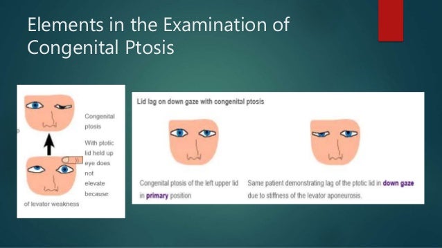 Adult ptosis