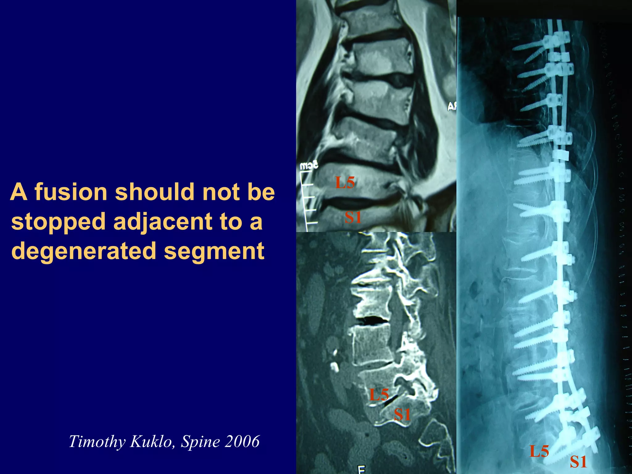 Adult Scoliosis Indications for Operative Treatment | PPT