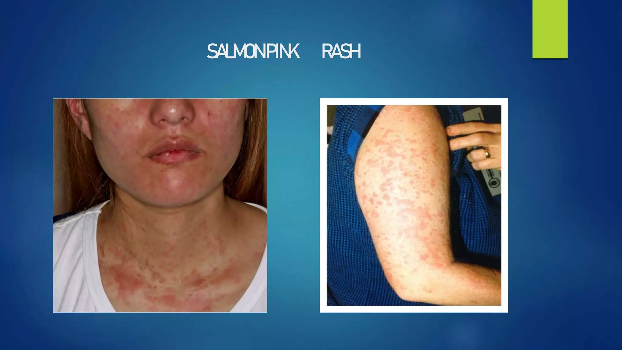 ADULT STILL’S DISEASE | PPTX