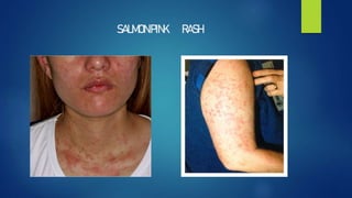 ADULT STILL’S DISEASE | PPTX