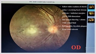 A Case report of Toxoplasma Retinochoroiditis | PPTX