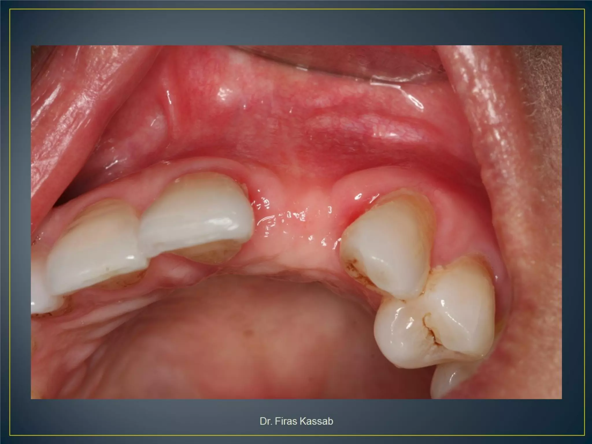 Advance bone preservation and regeneration | PDF