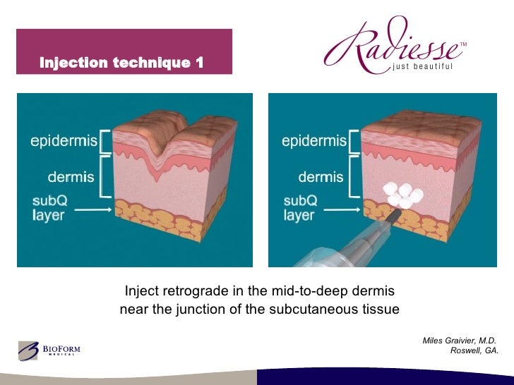 Advanced Radiesse Hand Lecture Final