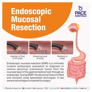 Endoscopic Mucosal Resection (EMR) - Procedure Indications & Cost | PDF