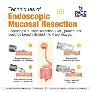 Endoscopic Mucosal Resection (EMR) - Procedure Indications & Cost | PDF