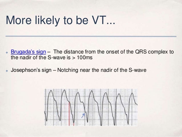 Advanced ecgs