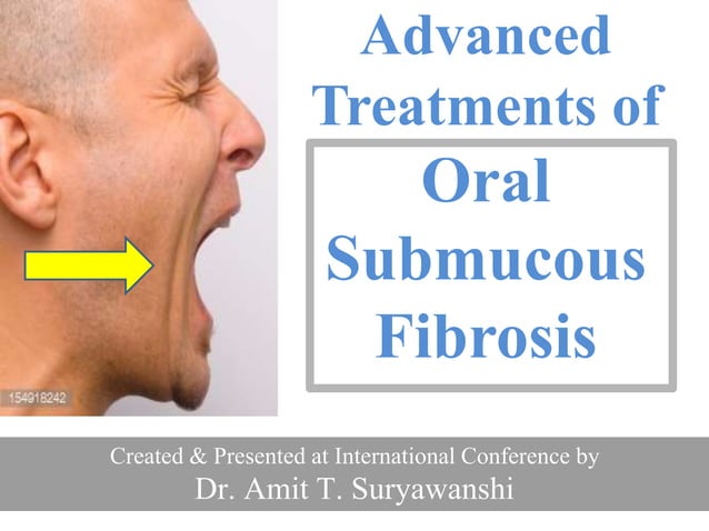 Advanced Treatment of Oral Submucous Fibrosis by Dr. Amit | PPT