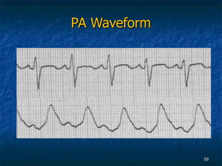 Advanced Hemodynamics | PPT