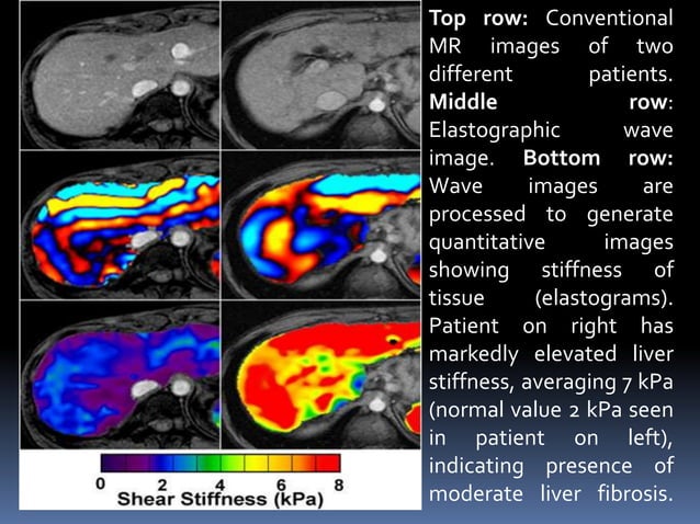 Advanced imaging modalities of the liver | PPT