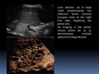 Advanced imaging modalities of the liver | PPTX