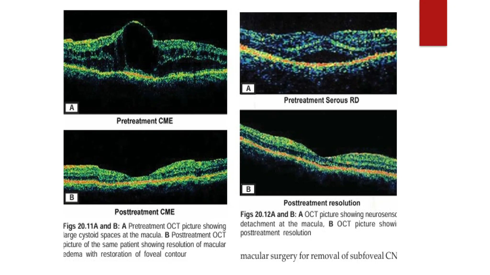 ADVANCED INVESTIGATIONS IN UVEITIS .pptx