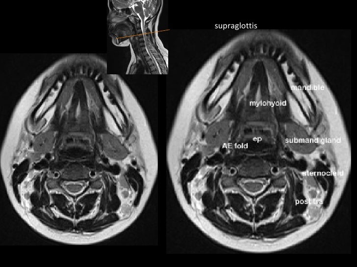 MRI in neck imaging
