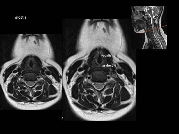 MRI in neck imaging