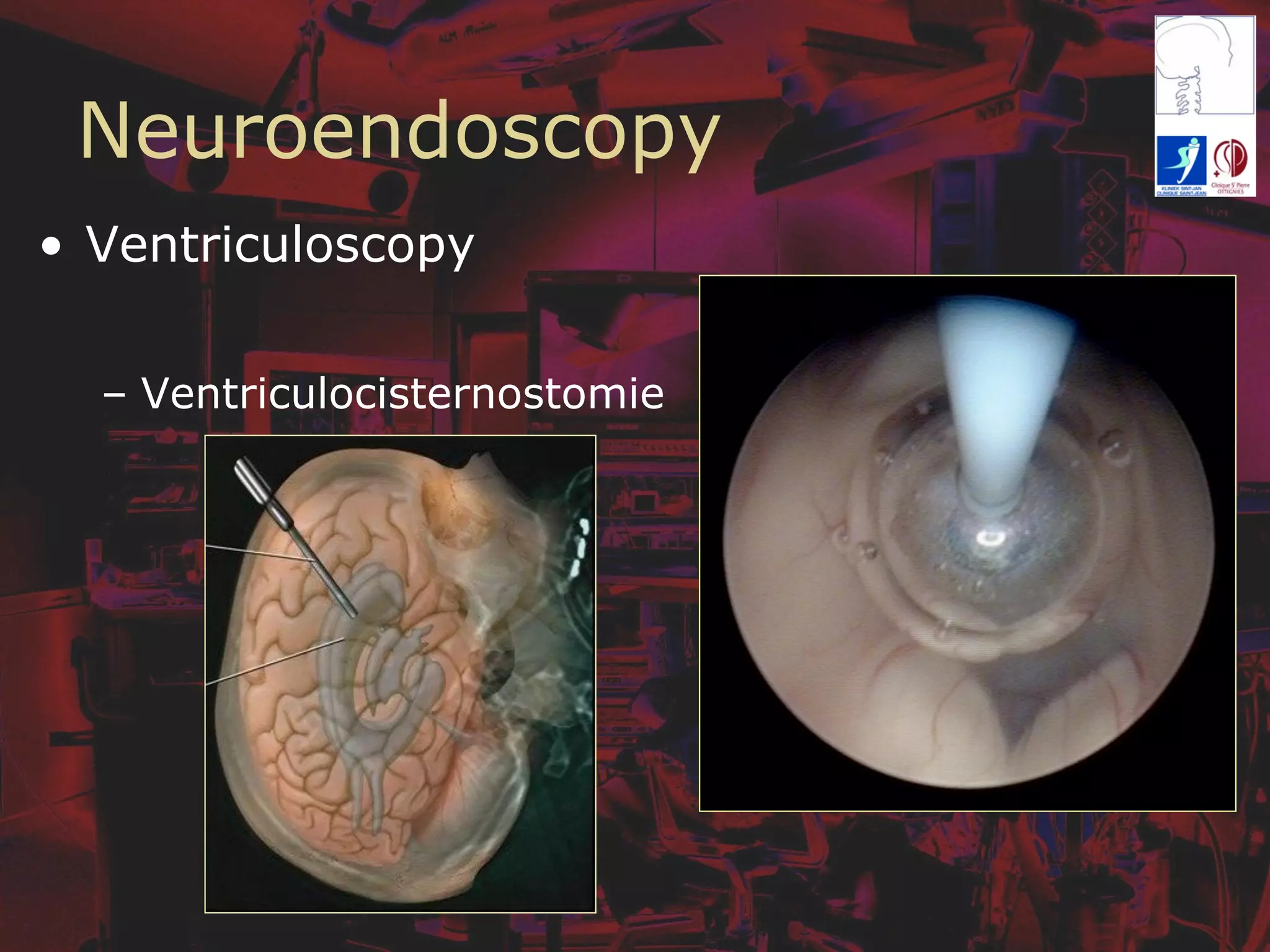 Advanced Neuro Endoscopy | PDF
