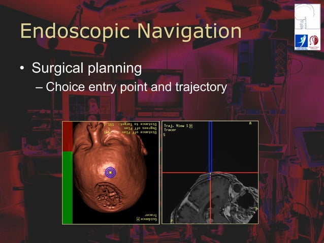 Advanced Neuro Endoscopy | PDF