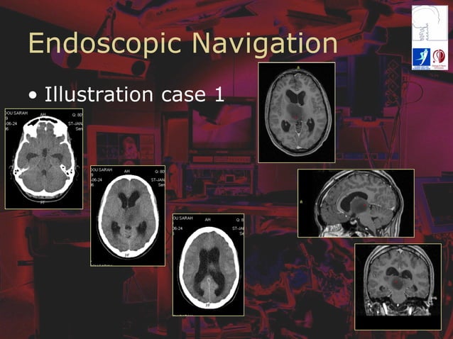 Advanced Neuro Endoscopy | PDF
