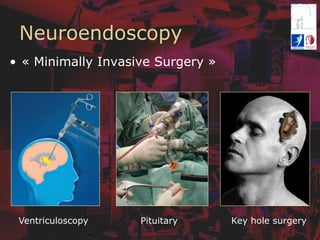 Advanced Neuro Endoscopy | PDF