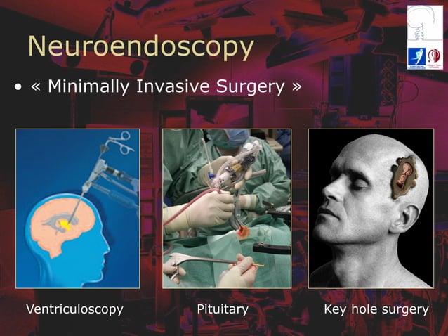 Advanced Neuro Endoscopy | PDF