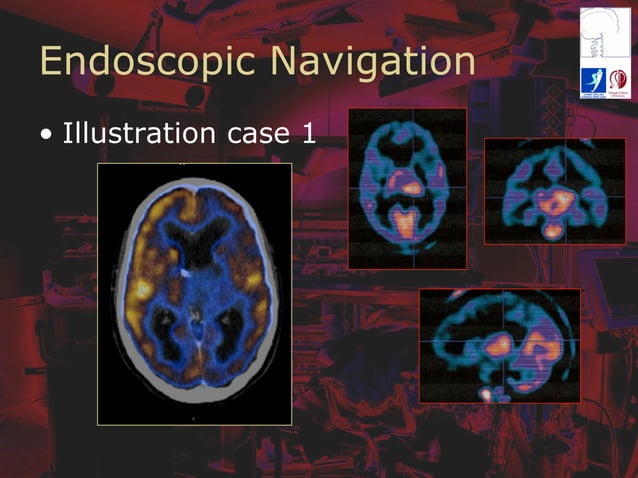 Advanced Neuro Endoscopy | PDF