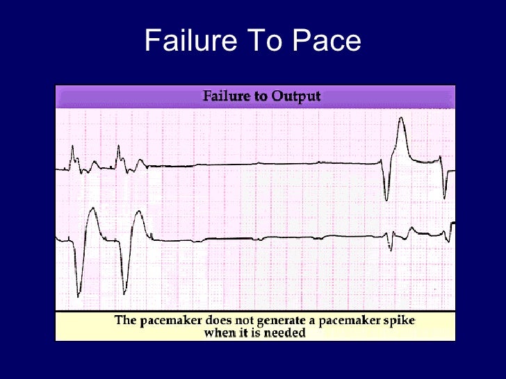 A D V A N C E D P A C I N G