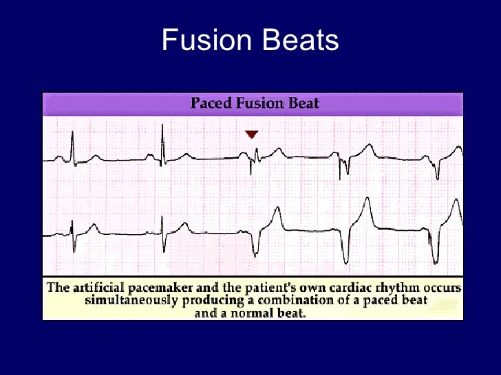 A D V A N C E D P A C I N G