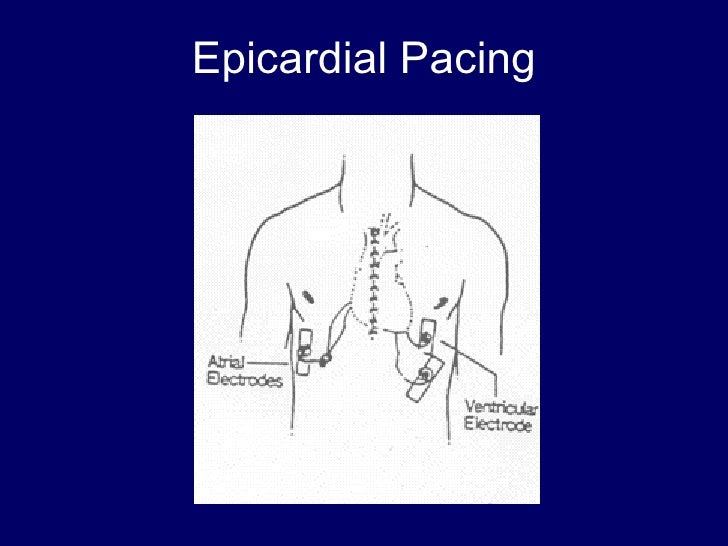 A D V A N C E D P A C I N G